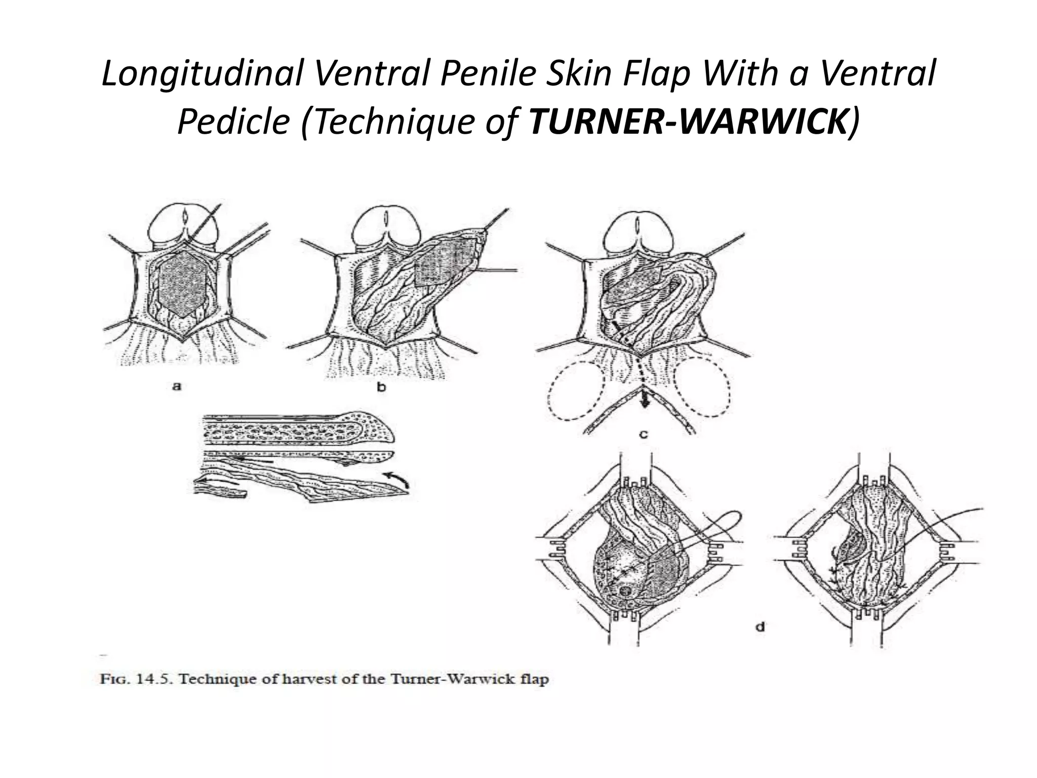 Surgical management of urethral stricture | PPTX