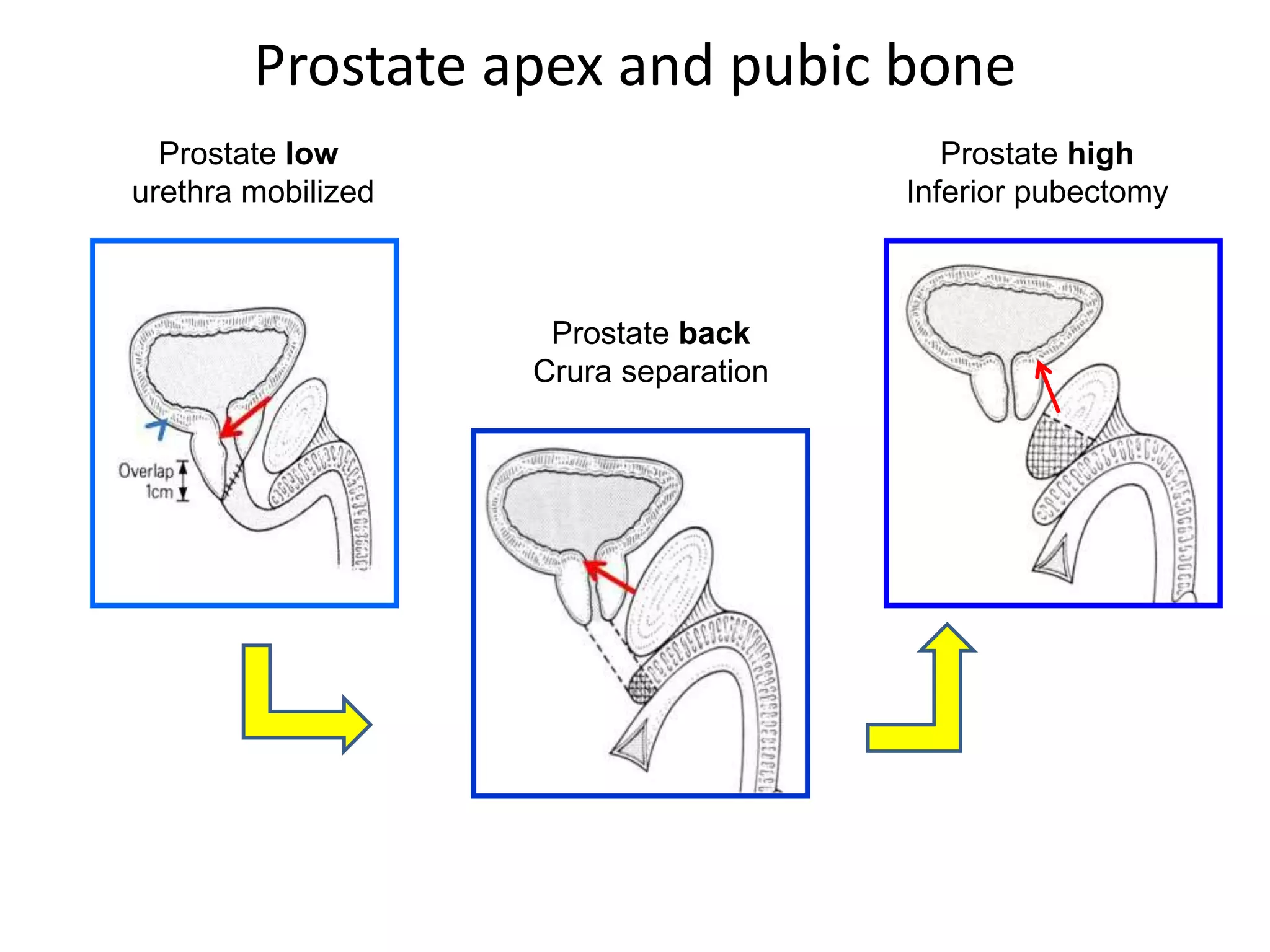 Surgical management of urethral stricture | PPTX