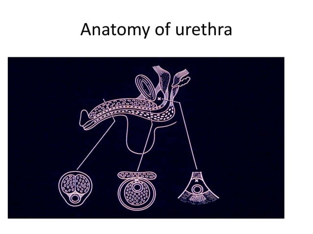 Surgical management of urethral stricture | PPTX | Sexual Conditions ...