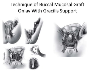 Surgical Management Of Urethral Stricture Pptx