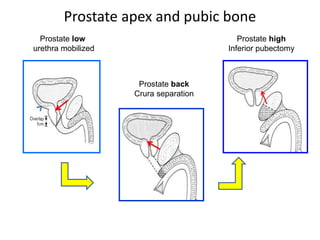 Surgical management of urethral stricture | PPTX