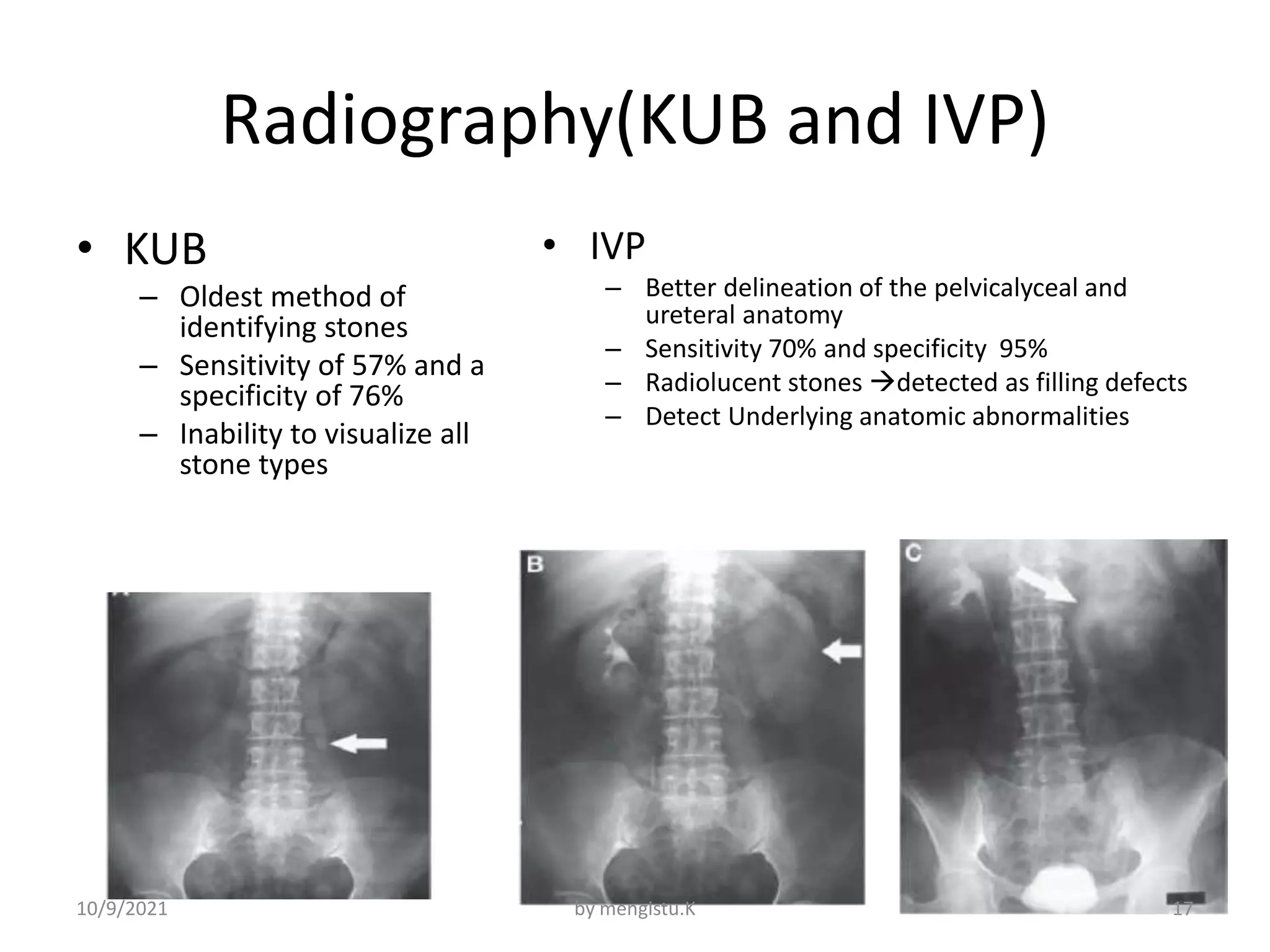 Surgical management of urolithiasis | PPTX