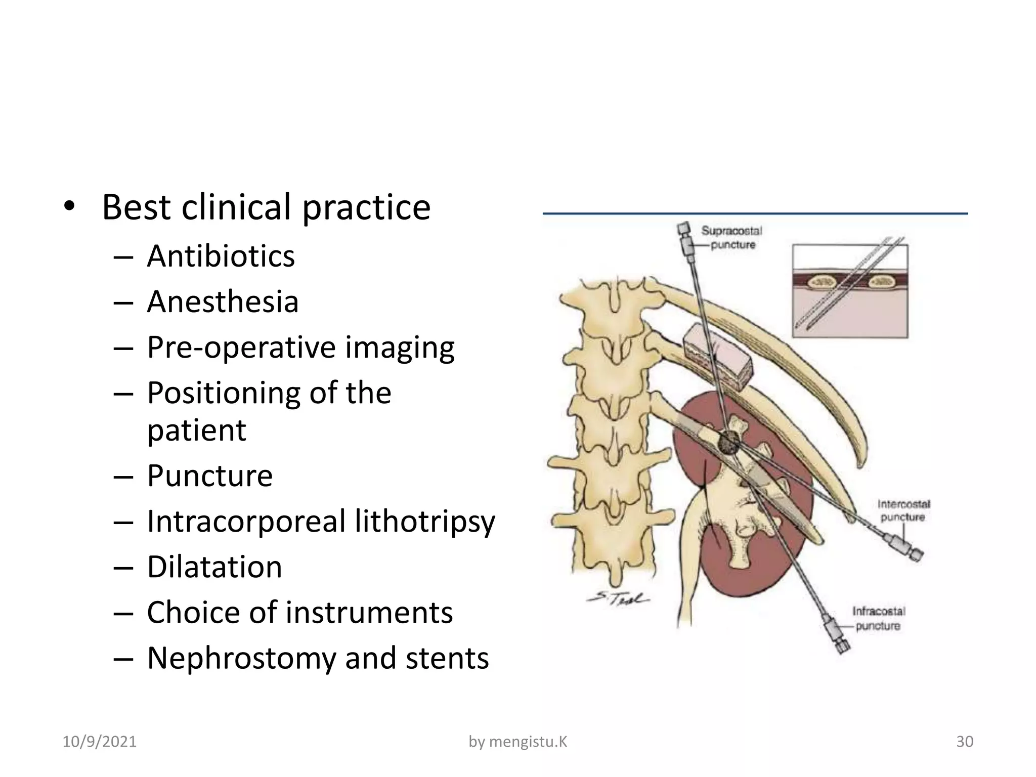 Surgical management of urolithiasis | PPTX