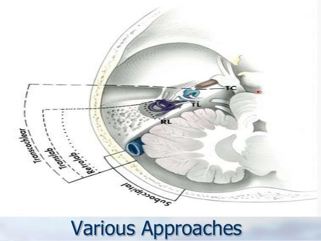 Surgical management of vestibular schwannoma by drdhiru456