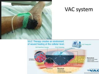 SURGICAL MANAGEMENT OF WOUNDS.pptx