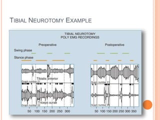 Surgical management of Spasticity | PPTX