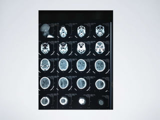 surgical mgt ICH of hemorraghic stroke. indications for surgery. | PPTX ...