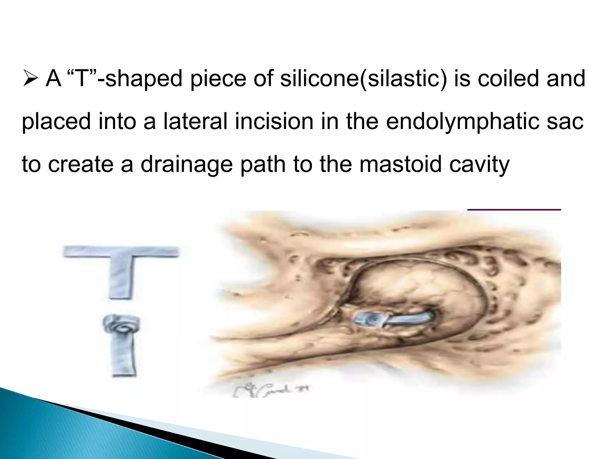 Surgical mx. of meneiers disease | PPTX | Ear, Nose and Throat ...