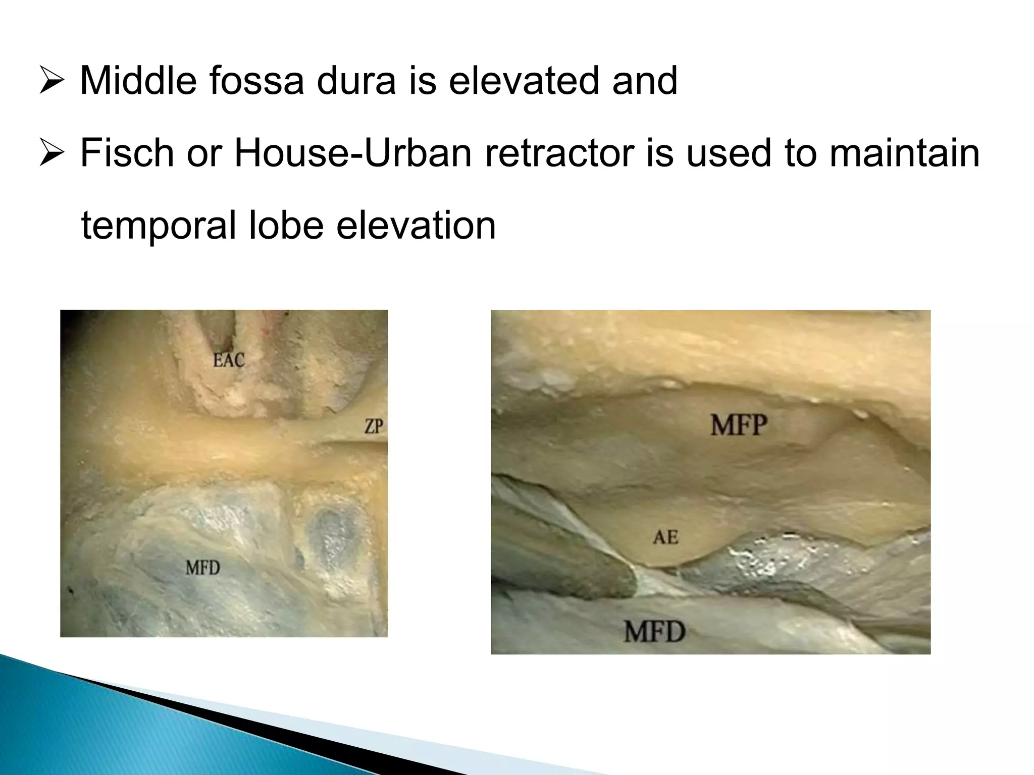 Surgical mx. of meneiers disease | PPTX | Ear, Nose and Throat ...