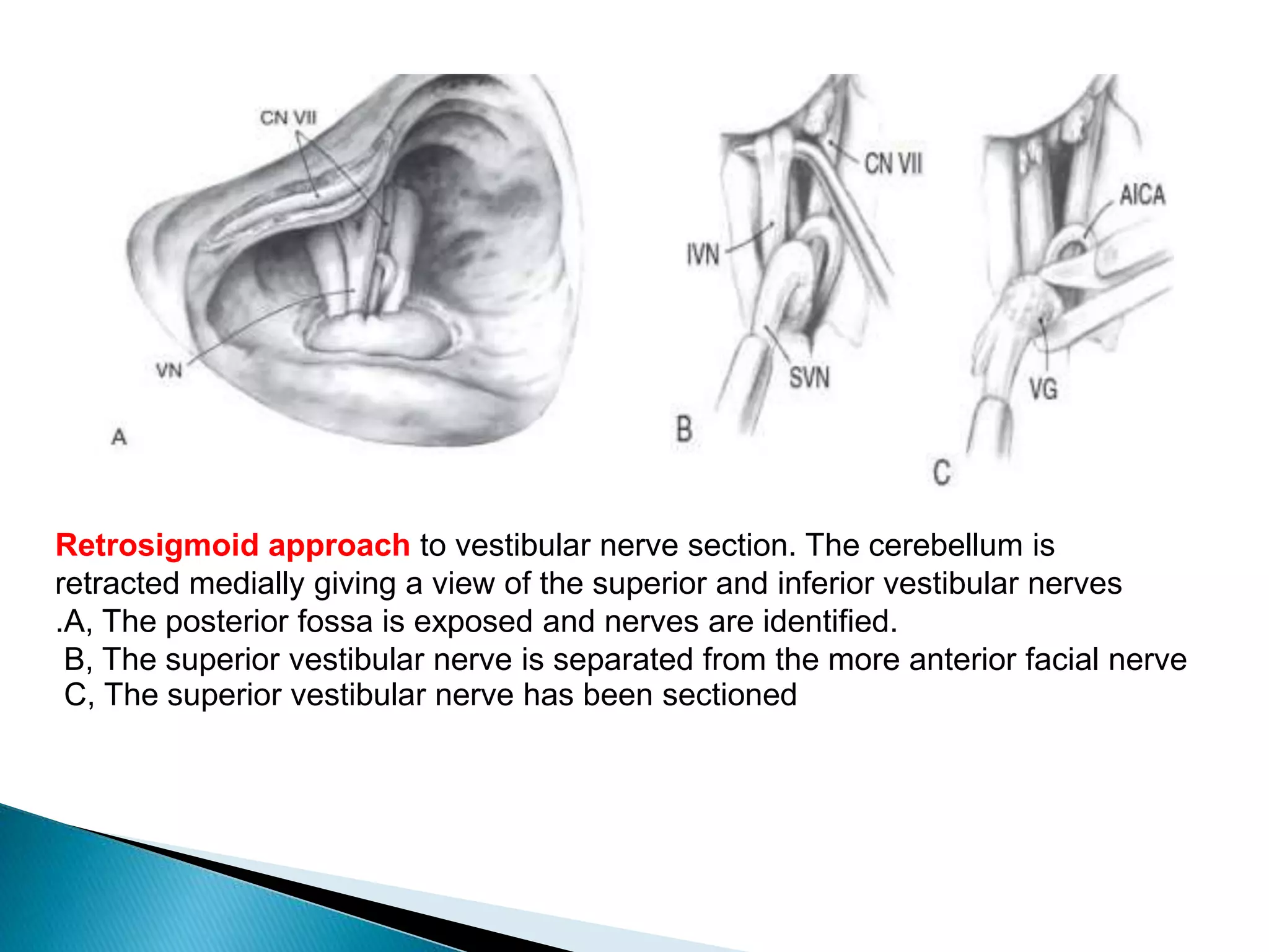 Surgical mx. of meneiers disease | PPTX | Ear, Nose and Throat ...