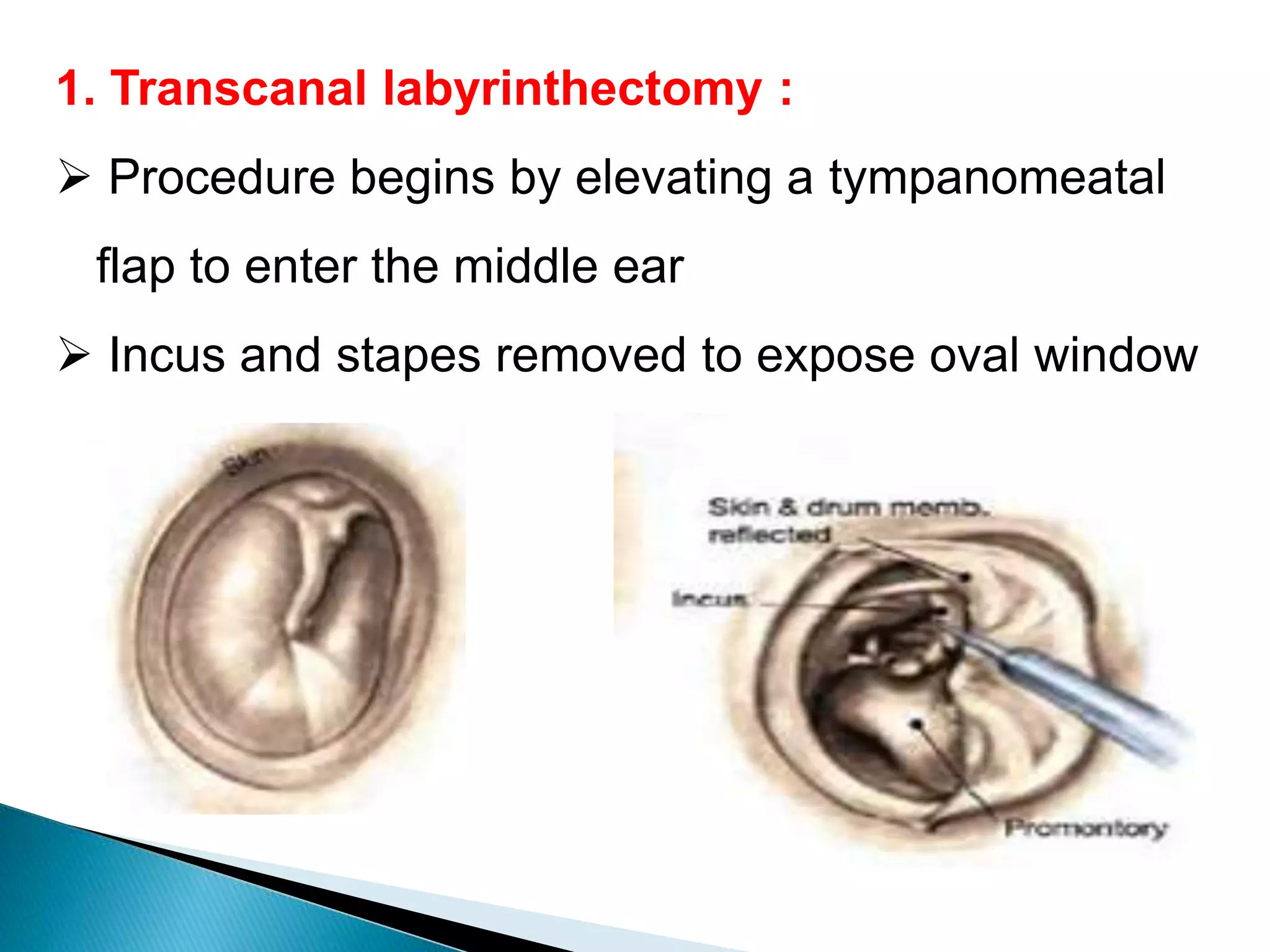 Surgical mx. of meneiers disease | PPTX | Ear, Nose and Throat ...