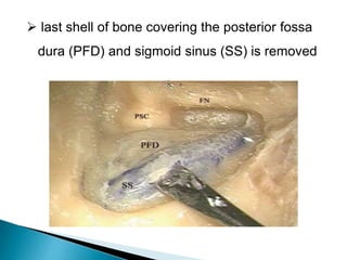 Surgical mx. of meneiers disease | PPTX