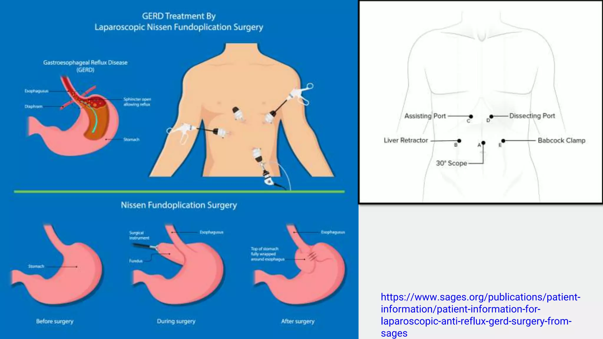 Surgical Management of GERD & Hiatal Hernia | PPTX