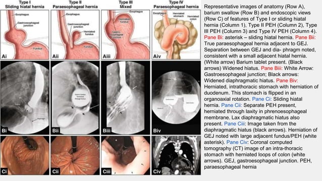 Surgical Management of GERD & Hiatal Hernia | PPTX | Digestive ...