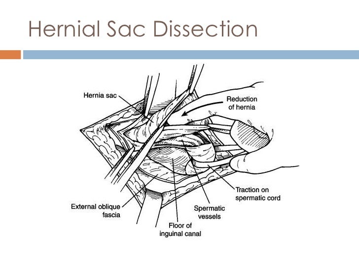 Uhd 4k Realtime Unedited Pediatric Inguinal Herniotomy