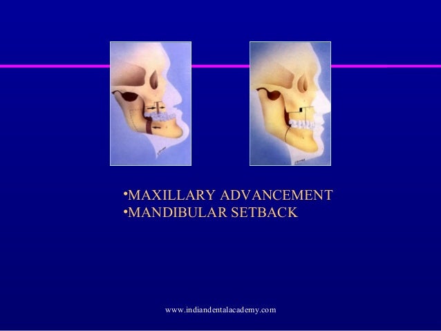 Surgical orthodontics