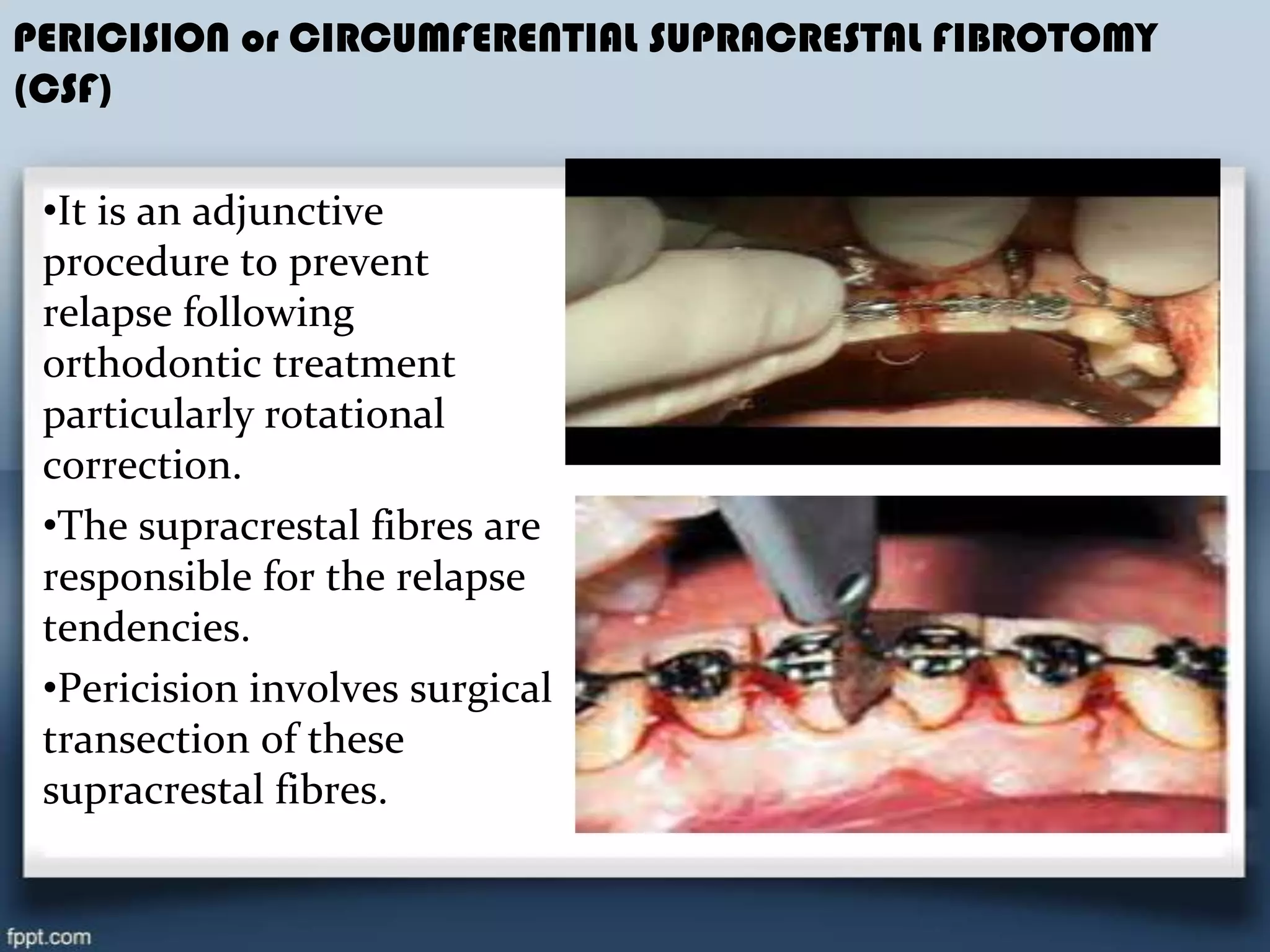 Surgical orthodontics-minor surgical procedures | PPTX