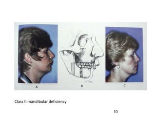 Surgery in orthodontics | PPTX
