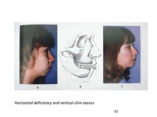 Surgery in orthodontics | PPTX