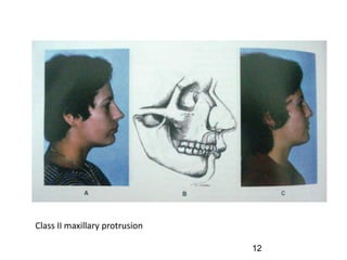Surgery in orthodontics | PPTX
