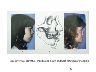 Surgery in orthodontics | PPTX