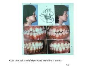 Surgery in orthodontics | PPTX
