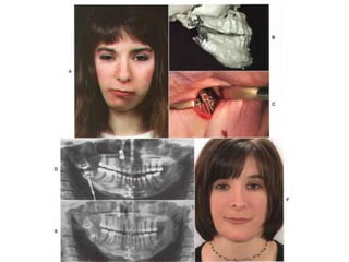 Surgery in orthodontics | PPTX