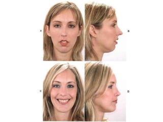 Surgery in orthodontics | PPTX