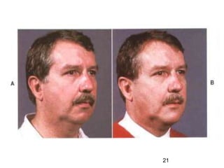 Surgery in orthodontics | PPTX