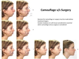 Surgery in orthodontics | PPTX
