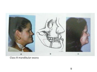 Surgery in orthodontics | PPTX