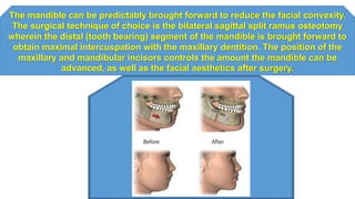 Surgical orthodontics dr maher fouda | PPTX