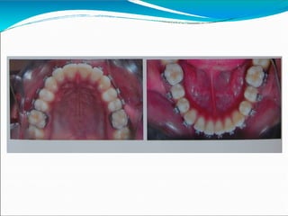 Comprehensive Surgical Orthodontics: Diagnosis, Treatment, and ...