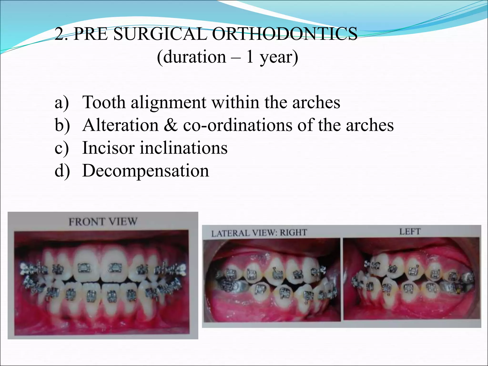 Surgical Orthodontics O.ppt