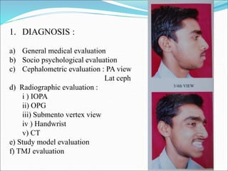 Surgical Orthodontics O.ppt