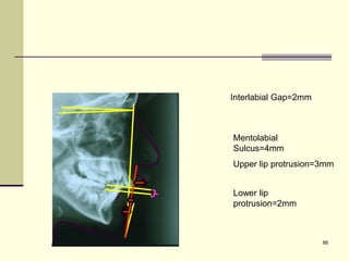 SURGICAL ORTHODONTIC TREATMENT.ppt