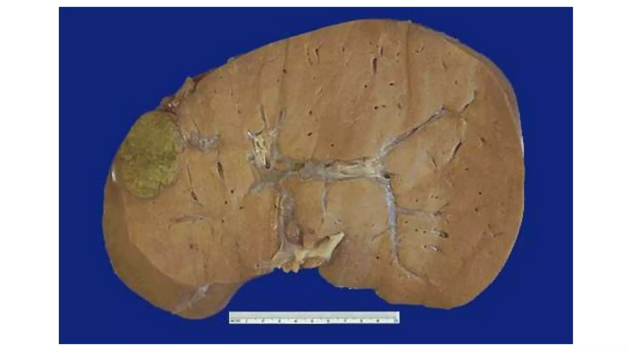 Surgical pathology of hepatobiliary tree and pancreas | PPT