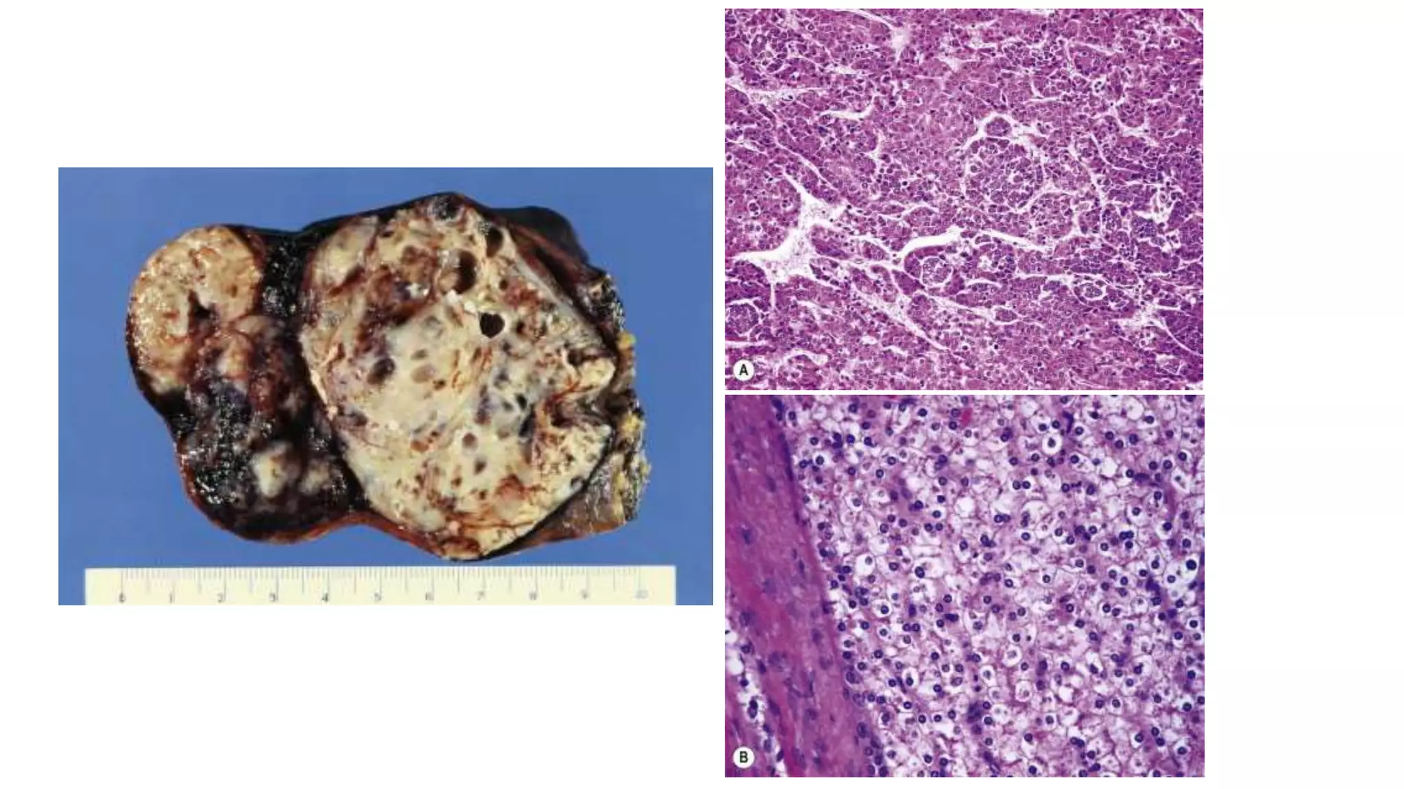 Surgical pathology of hepatobiliary tree and pancreas | PPT