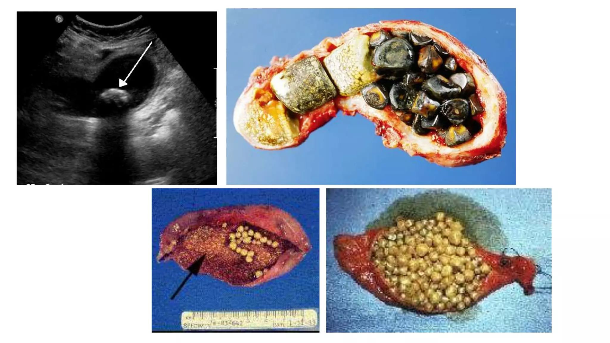 Surgical pathology of hepatobiliary tree and pancreas | PPT