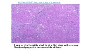 Surgical pathology of hepatobiliary tree and pancreas | PPTX