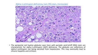 Surgical pathology of hepatobiliary tree and pancreas | PPTX