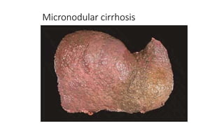 Surgical pathology of hepatobiliary tree and pancreas | PPTX