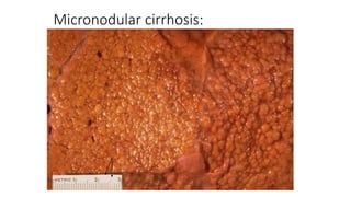 Surgical pathology of hepatobiliary tree and pancreas | PPTX