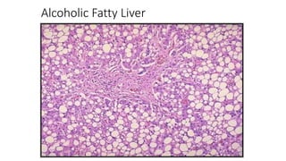 Surgical pathology of hepatobiliary tree and pancreas | PPTX