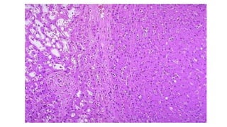 Surgical pathology of hepatobiliary tree and pancreas | PPTX
