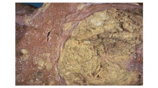 Surgical pathology of hepatobiliary tree and pancreas | PPTX