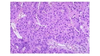 Surgical pathology of hepatobiliary tree and pancreas | PPTX