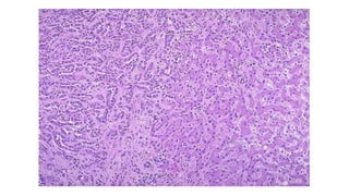 Surgical pathology of hepatobiliary tree and pancreas | PPTX