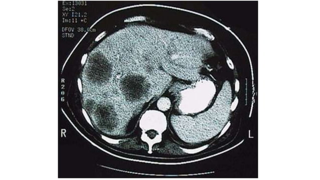 Surgical pathology of hepatobiliary tree and pancreas | PPT