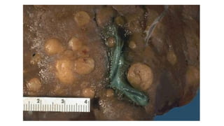 Surgical pathology of hepatobiliary tree and pancreas | PPTX